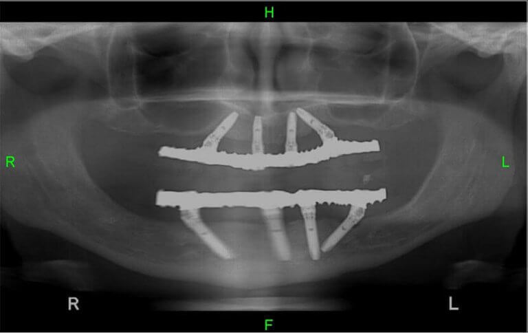 All on 4 dental Implant Method, what is it? | Dr Balan